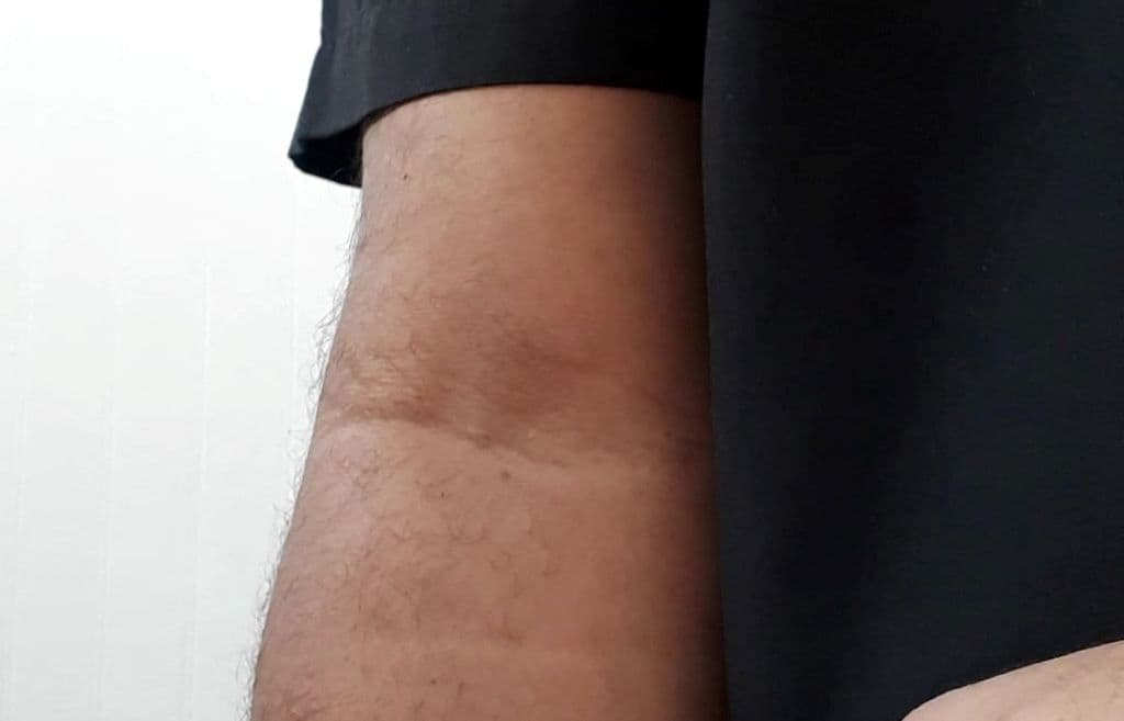 Mastering Vein Selection: Tips for a Successful Venipuncture ...